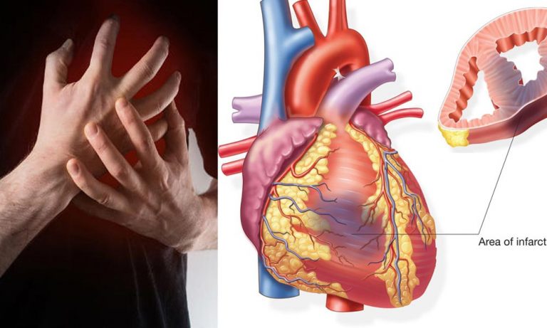 Ce este și care sunt semnele infarctului miocardic acut? | Cardiolog ...